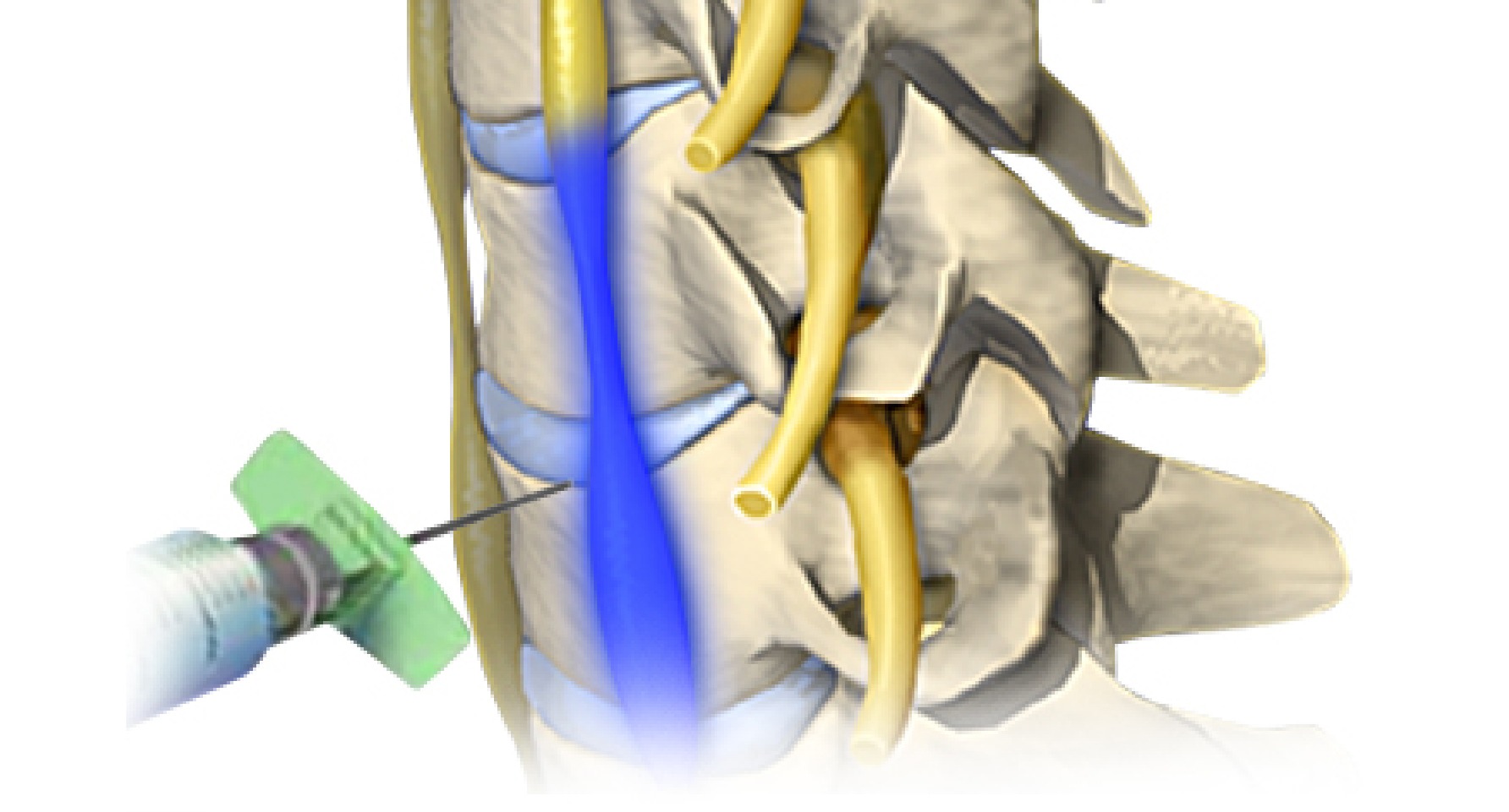 Stellate Ganglion Block | FX Spine & Pain Center Evans, GA