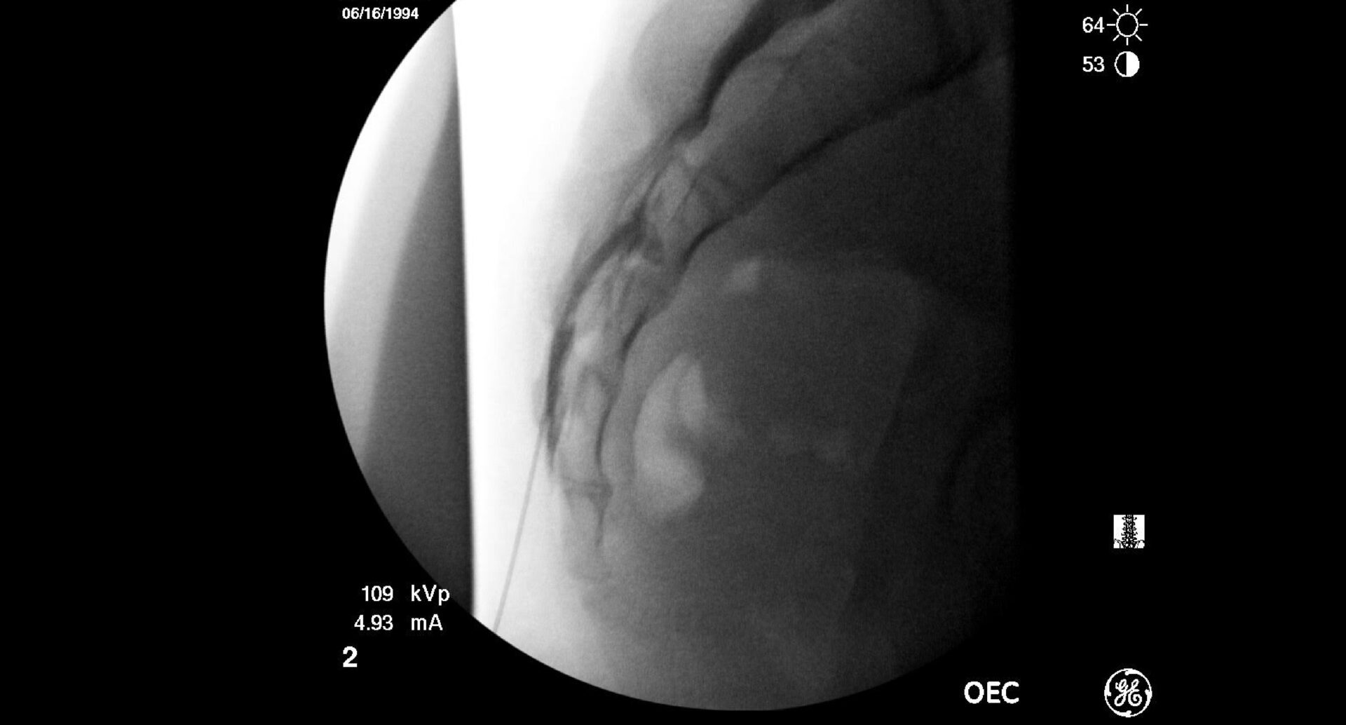 Caudal Epidural Steroid Injection | FX Spine Center Evans, GA