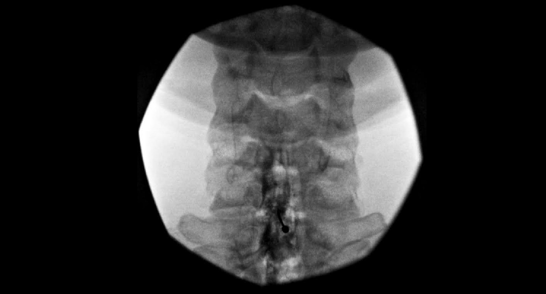 Cervical Epidural Steroid Injection | FX Spine & Pain Center Evans, GA