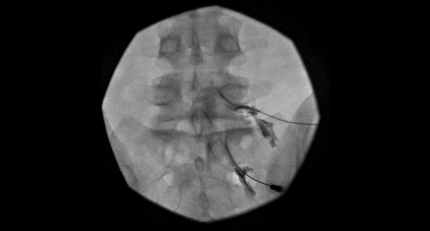 Lumbar Transforaminal Steroid Injection | FX Spine & Pain Center Evans, GA