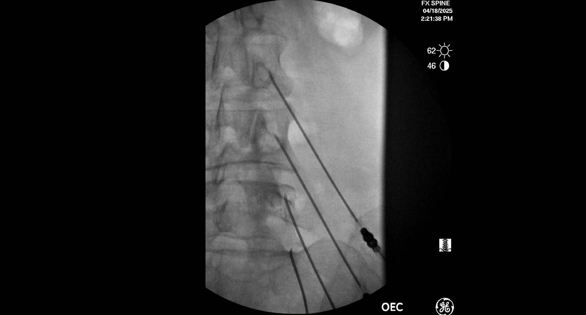 Radiofrequency Nerve Ablation | FX Spine & Pain Center Evans, GA